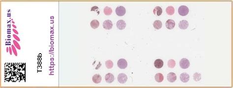 T388b Malignant Melanoma Tissue Array Including Tnm And Clinical Stage 6 Cases 24 Cores