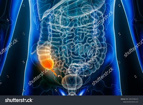 Appendicitis Disease Vermiform Appendix Inflammation 3d Stock