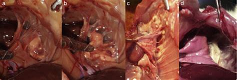 A B The Pleural Adhesions And Pleurodesis Success Of Sericin C D