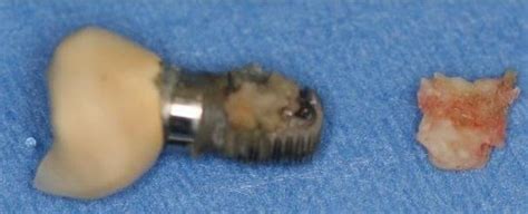 Dental Implant Removed From Left Posterior Maxilla With Necrotic Bone