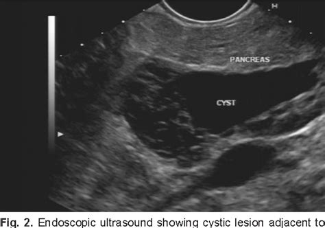 Figure 2 From Retroperitoneal Cystic Lymphangioma Diagnosed By