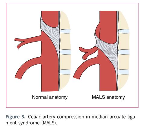 Medial Arcuate Ligament