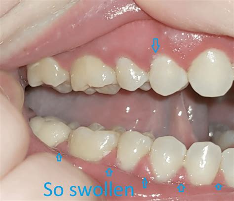 Necrotizing Gingivitis Or Herpetic Gingivostomatitis Or R