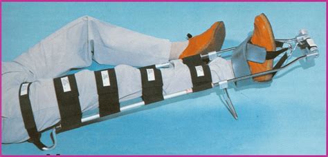 Femur Fracture In The Ed Remove The Traction County Em