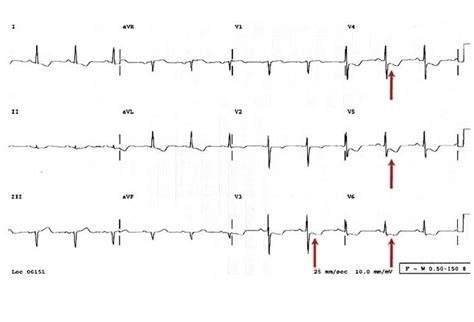 Aortic Dissection Aortic Dissection Ecg