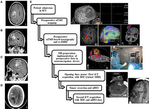 Frontiers Case Report Multimodal Functional And Structural Evaluation Combining Pre Operative