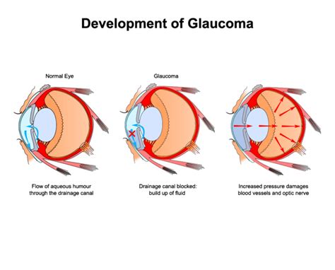 Glaucoma Honolulu Glaucoma Testing Honolulu Sugiki Portis Yim Eye Hi