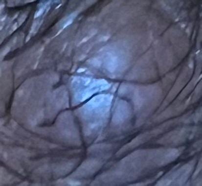 여자 생식기주변 염증 지식in