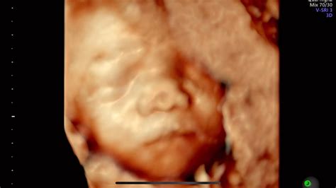 58 28주 입체 초음파 요약 Youtube