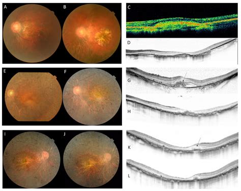 Genetic And Phenotypic Landscape Of Prph2 Associated Retinal Dystrophy In Japan