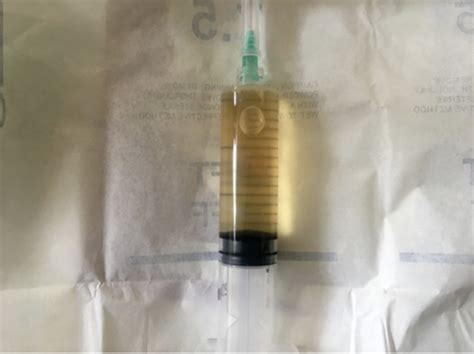 Turbid Synovial Fluid At Alison Mclemore Blog