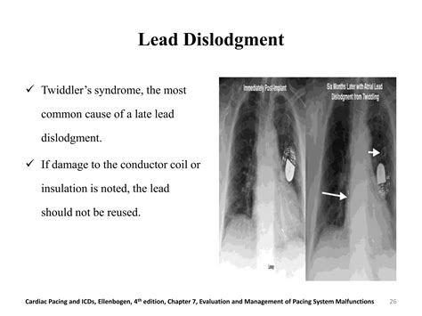 Evaluation And Management Of Pacemaker Malfunction Pptx