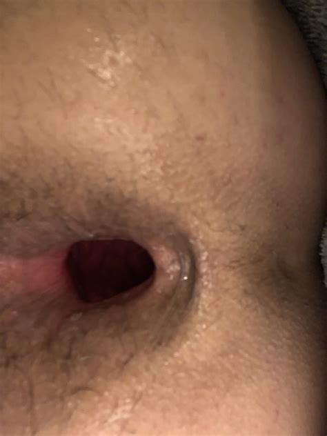 Extreme Anal Insertiongaping Page 2 Xnxx Adult Forum
