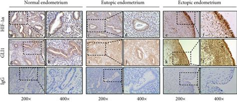 Differential expression of GLI1 and HIF 1α in normal eutopic and