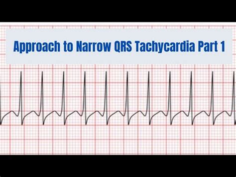 Narrow Qrs Complex