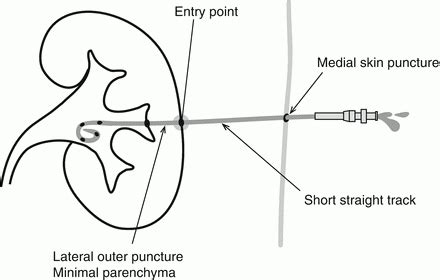 Percutaneous Nephrostomy Abdominal Key