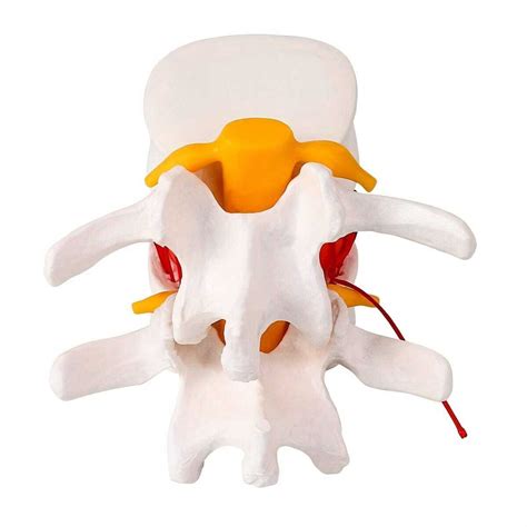 Human Anatomical Lumbar Disc Herniation Model Lumbar Spine Model For Teaching And Learning