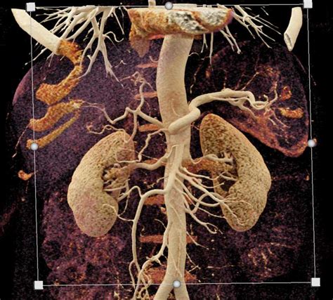 Portal Vein And Superior Mesenteric Vein Smv Encasement By Pancreatic