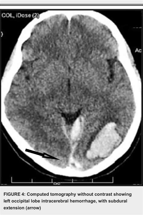 Figure 4 From Infective Endocarditis Masked By Narrow Focus Thinking Inadequate Physical