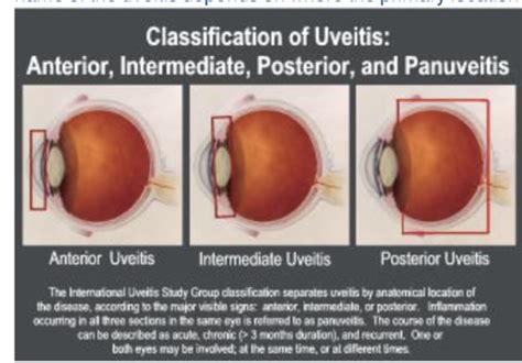 8 Anterior Uveitis Presentation And Ocular Treatment Flashcards Quizlet