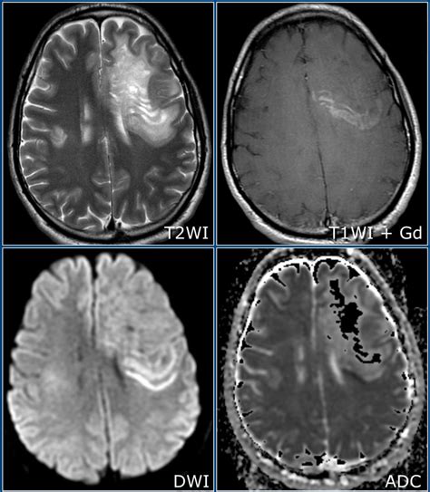 The Radiology Assistant Multiple Sclerosis