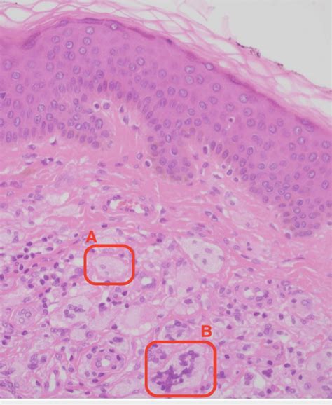 Foamy Histiocytic Cells Labelled A And Multi Nucleate Giant Cells Download Scientific Diagram