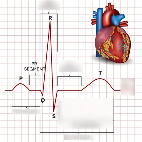 ECG Rules BBB S And STEMI Imposters Diagram Quizlet