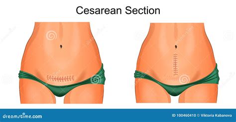 Cesarean Section Icon On White Cartoon Vector