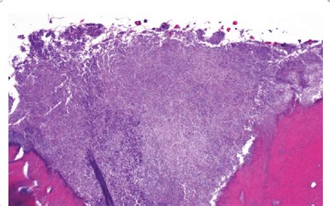 High Power View Demonstrates Colony Of Actinomyces Purple Staining