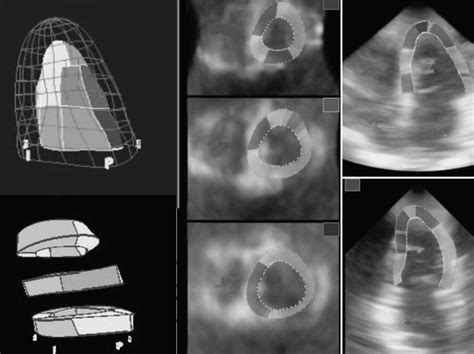 Three Dimensional Speckle Tracking Echocardiography Showed