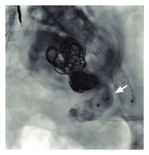 Post Treatment Fluoroscopic Image Without Injection Showing Additional
