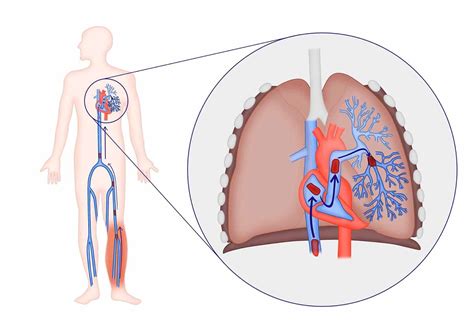 Procedimientos Innovadores Para El Tromboembolismo Pulmonar Foro