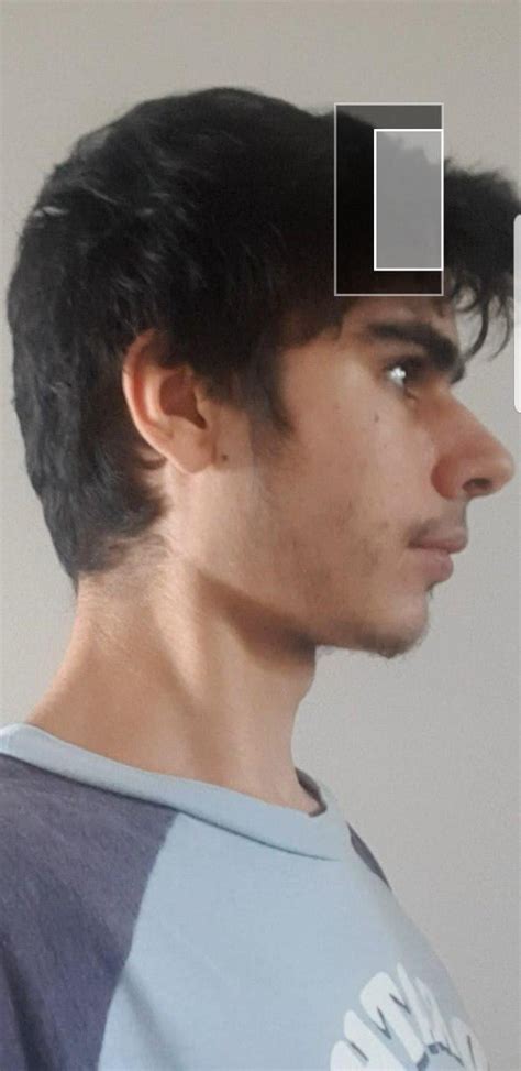 Could This Be Icr Or Am I Overthinking It Idiopathic Condylar