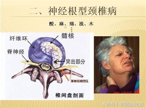 頸椎病常見類型之一：神經根型的發病機制和臨床特點 每日頭條
