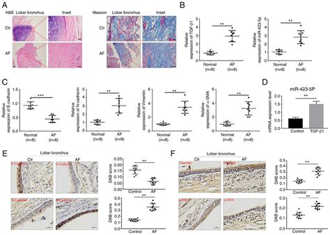 MiR 423 5p Expression In Human AF Tissue And BEAS 2B Cells Treated With