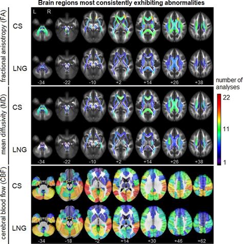 Heat Maps Showing Brain Regions Most Consistently Exhibiting