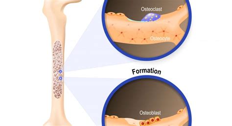 Understanding Bone Resorption Aquidneck Chiropractic