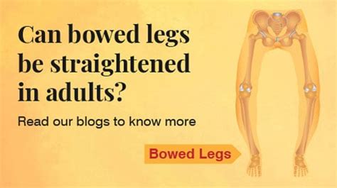 Genu Valgum Knock Knees Causes Symptoms Treatment 43 Off