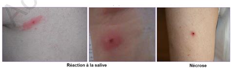 Figure 2 From Lyme Borreliosis And Other Tick Borne Diseases