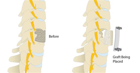 Cervical Corpectomy Anterior Seattle Wa Brain And Spine Surgery