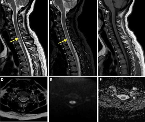 Spinal Cord Infarction