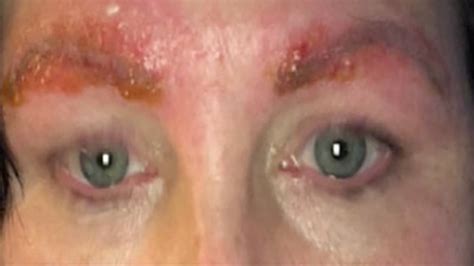 Woman Gets Potential Life Threatening Infection After