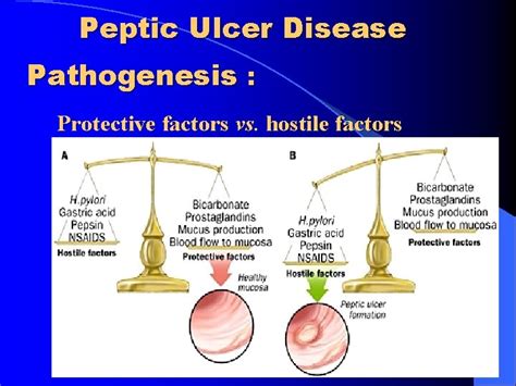 Gastric And Duodenal Ulcer Disease Anatomy Arterial Blood