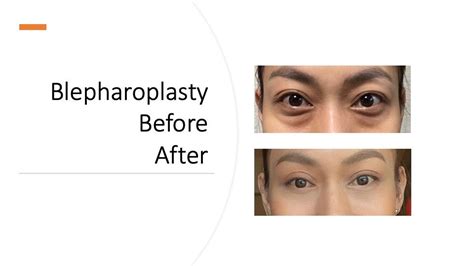 What Is The Difference Between Cosmetic Blepharoplasty And Functional