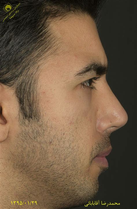 نمونه کارهای جراحی بینی دکتر راجی