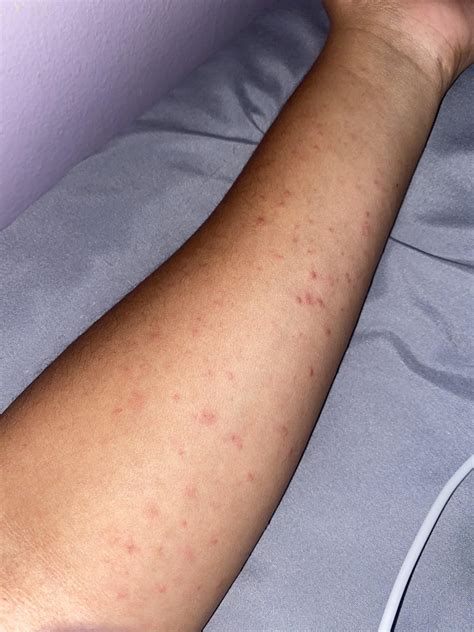 Contact Dermatitis Rallergy