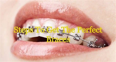 Steps To Get The Perfect Braces In Winnipeg Info Captain