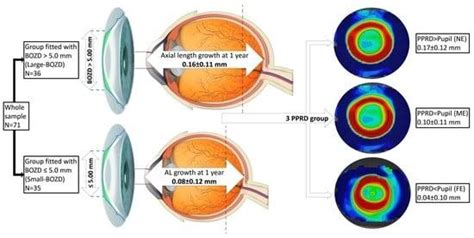 Shonit Jagmohan On Linkedin The Role Of Back Optic Zone Diameter In