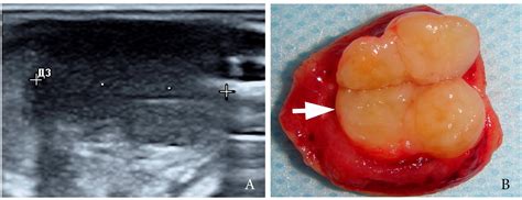 Schwannoma Of The Tongue Ultrasonography