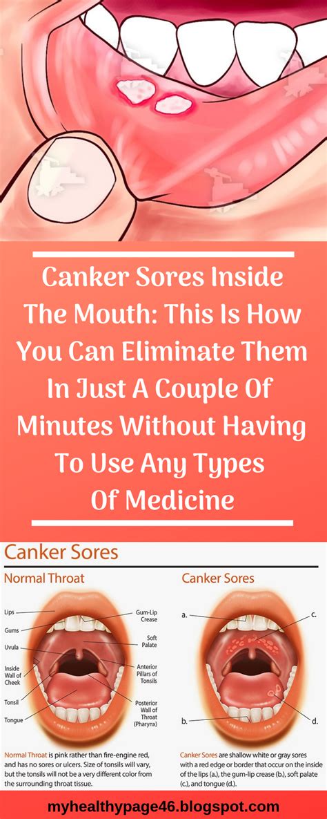 Canker Sore Inside Cheek